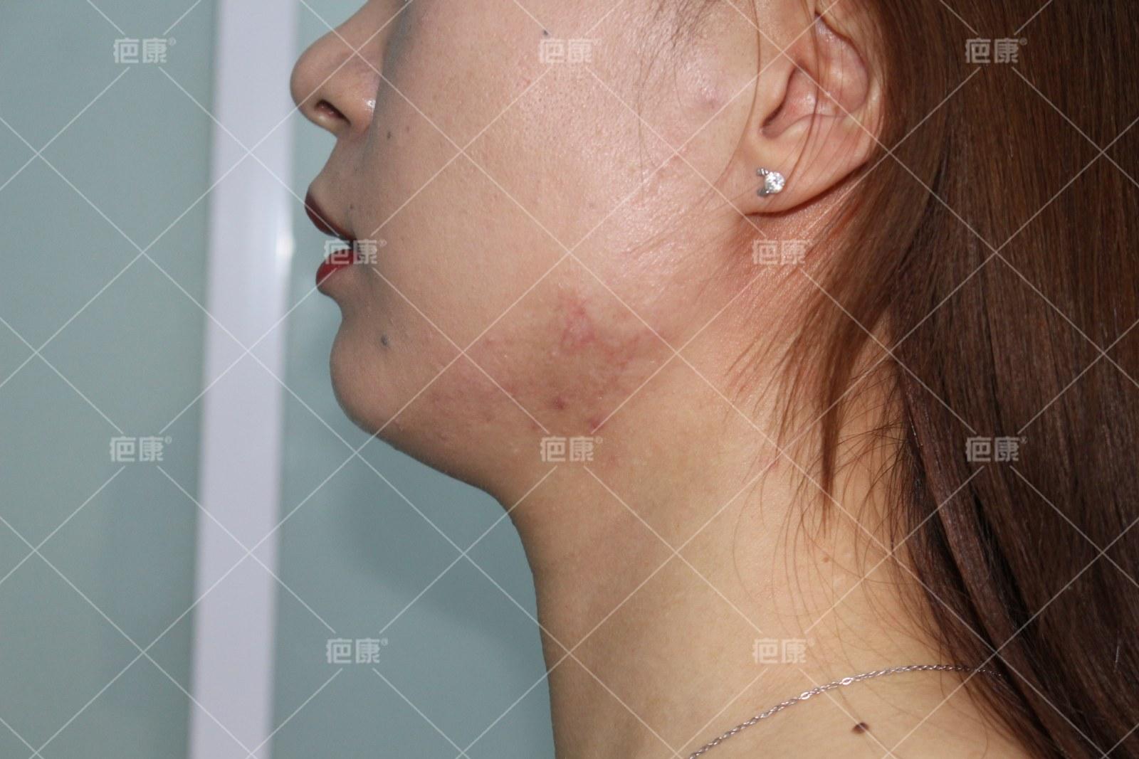 (Scar Kang) There are keloids on my face, I dare not look at people - iNEWS