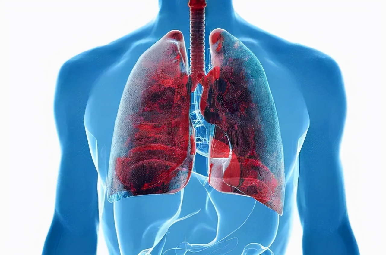 For long-term smokers, if there are 4 phenomena in the upper body, it ...