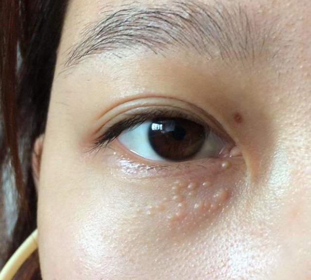 What should I do if there are fat particles on my face? - iNEWS