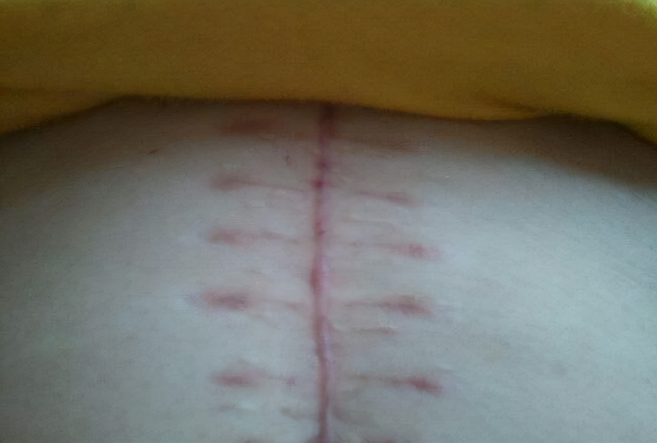 How to choose the "horizontal and vertical" cesarean section?Which is ...