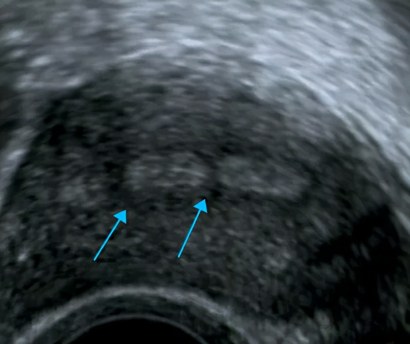 Uterine adhesions "sometimes and sometimes no" under ultrasound - iNEWS