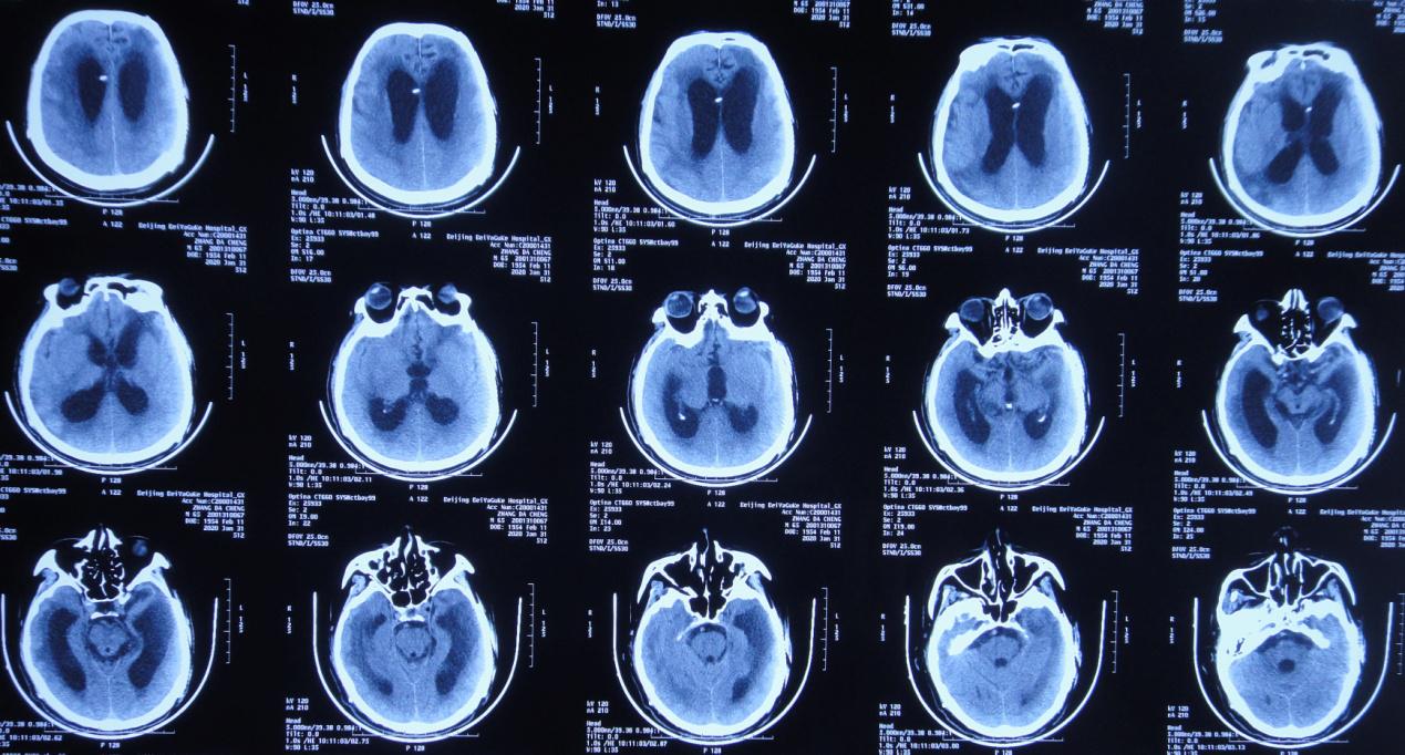 Hydrocephalus after craniocerebral trauma, skull repair caused ...