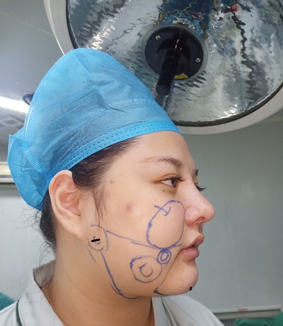 Do you know about body liposuction, including which parts and how many ...