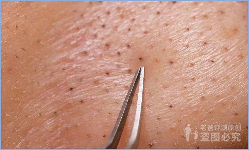 How are the blackheads going? We pulled out and enlarged four types of ...