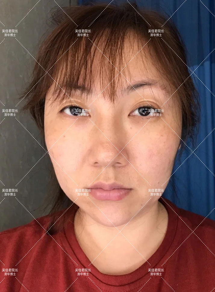 Afraid of obvious scars and bad results after face lift?She used her ...