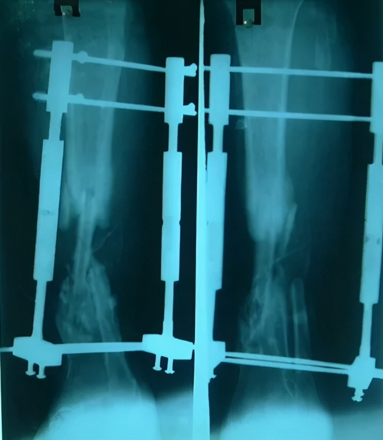 There are three types of nonunion fractures. Check your seats and see ...