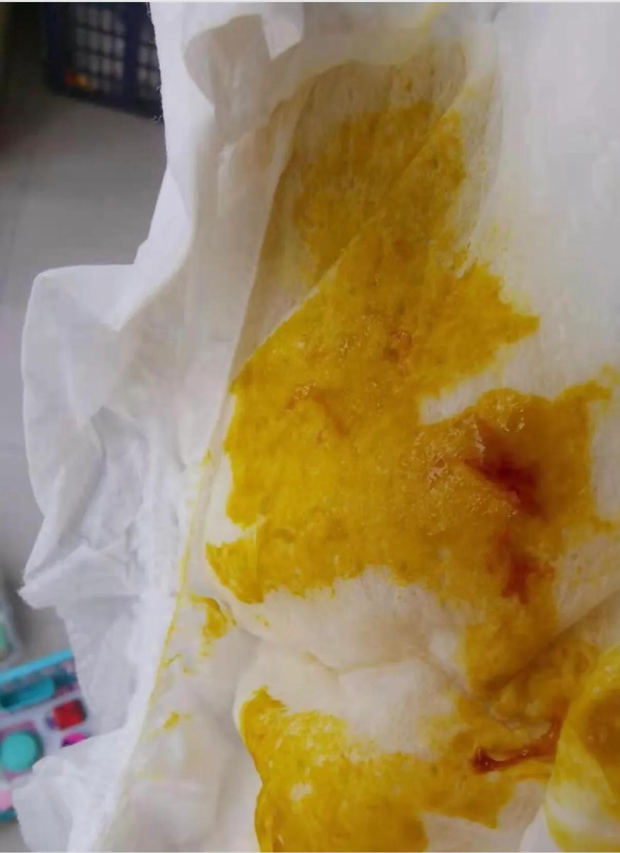 Baby has blood in the stool - iNEWS