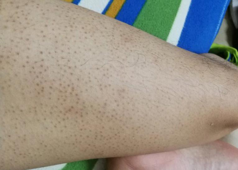 What should I do if I have a lot of goose bumps on my arms and legs?4 ...
