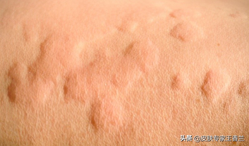Urticaria (wind mass), may be caused by allergies - iNEWS