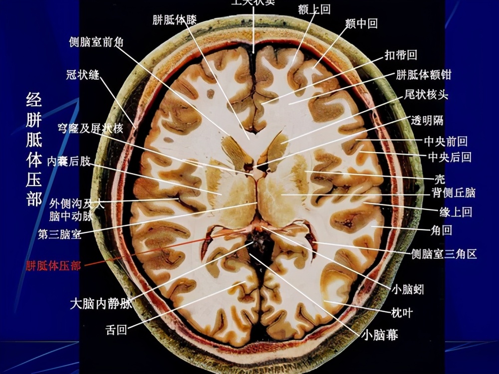 Alcoholic brain atrophy is due to long-term drinking, severe damage ...