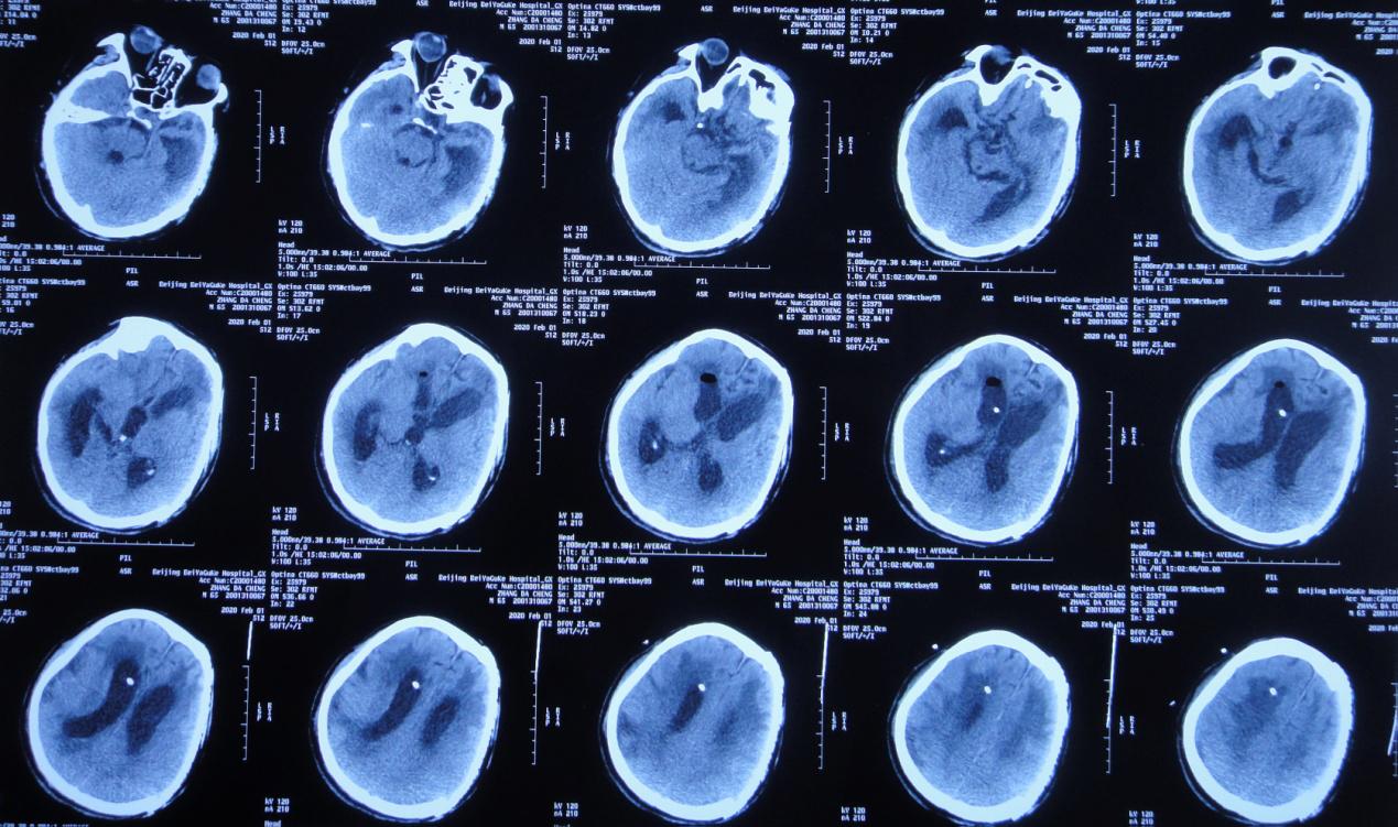 Hydrocephalus after craniocerebral trauma, skull repair caused ...