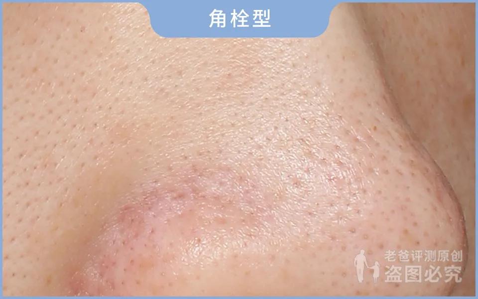 How are the blackheads going? We pulled out and enlarged four types of ...