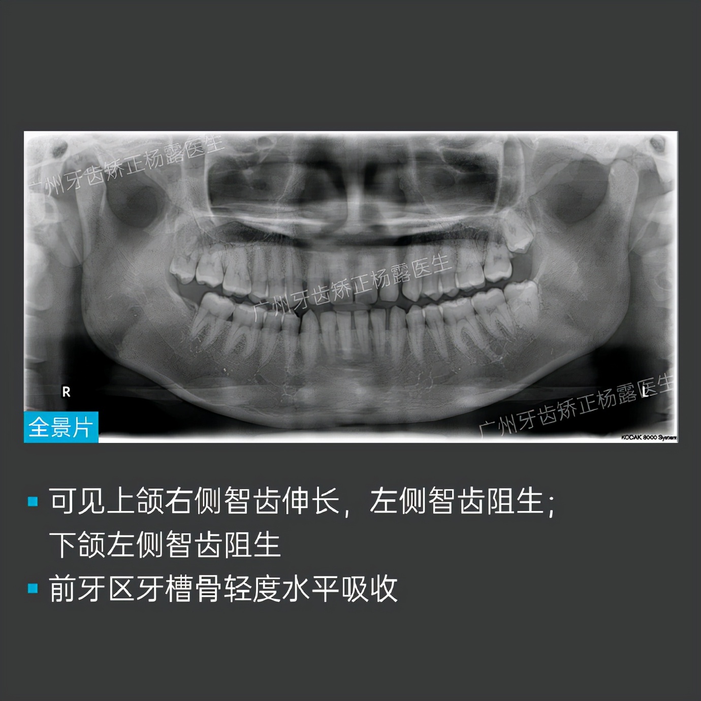 Bone Class I mandibular protrusion + gap between upper and lower ...
