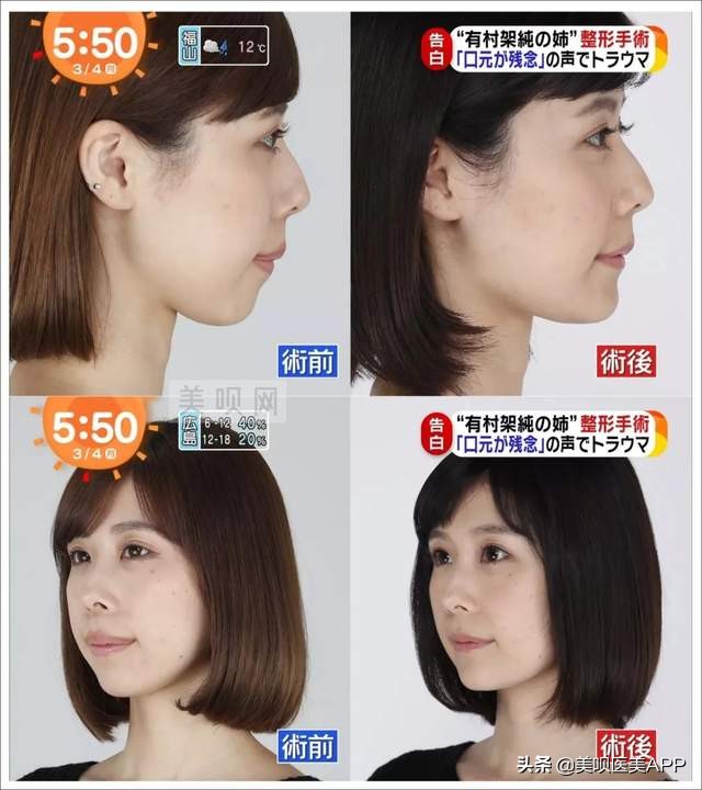 Look at the protruding girl!How can I improve the protruding mouth ...