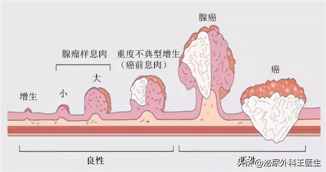 "Unspeakable" anal cancer, do you understand it?If you have several ...