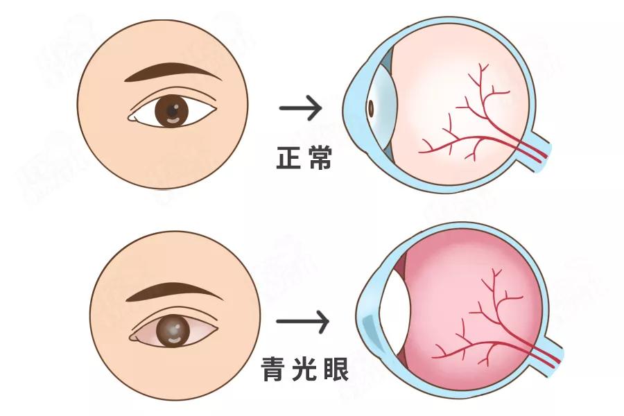 This kind of congenital eye disease can easily lead to dacryocystitis ...