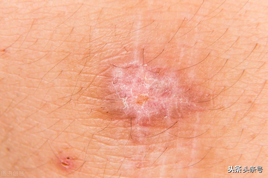 What is the redness of the wound after the scab is gone?These points to ...