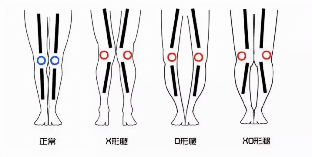 How to correct XO legs through yoga and store them properly - iNEWS