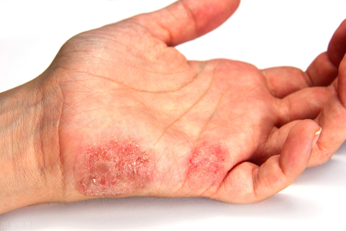 In the summer, ringworm of the hand occurs frequently, and there are ...