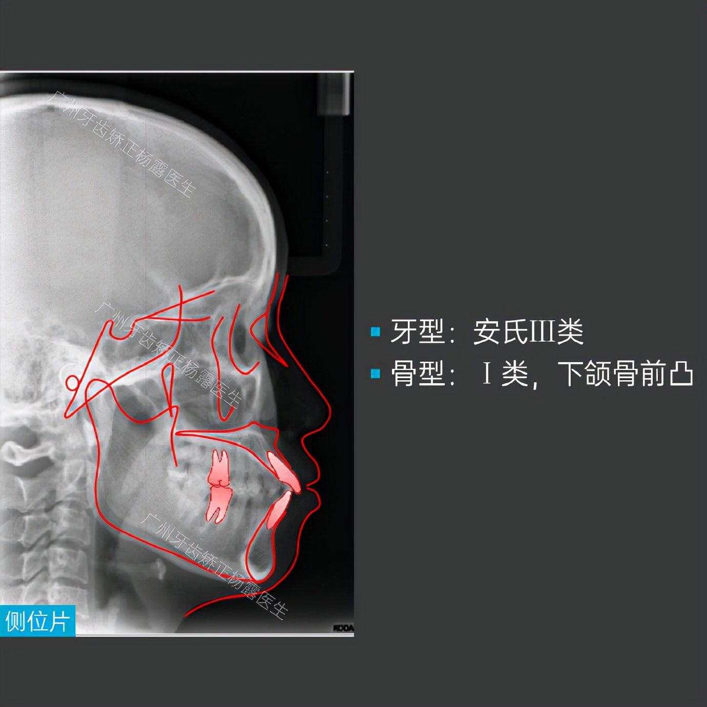 Bone Class I mandibular protrusion + gap between upper and lower ...