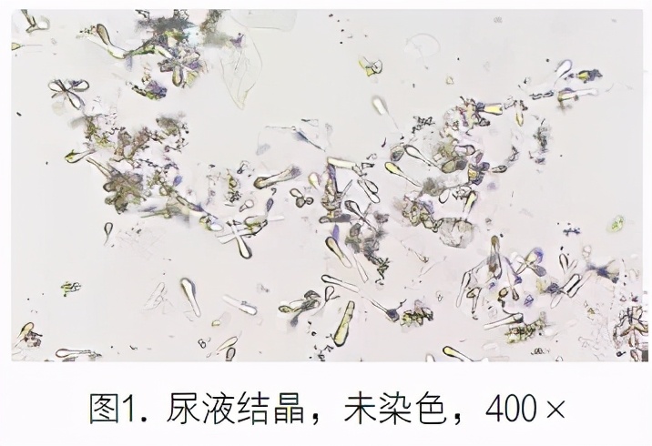 Key points for the identification of special forms of calcium oxalate ...