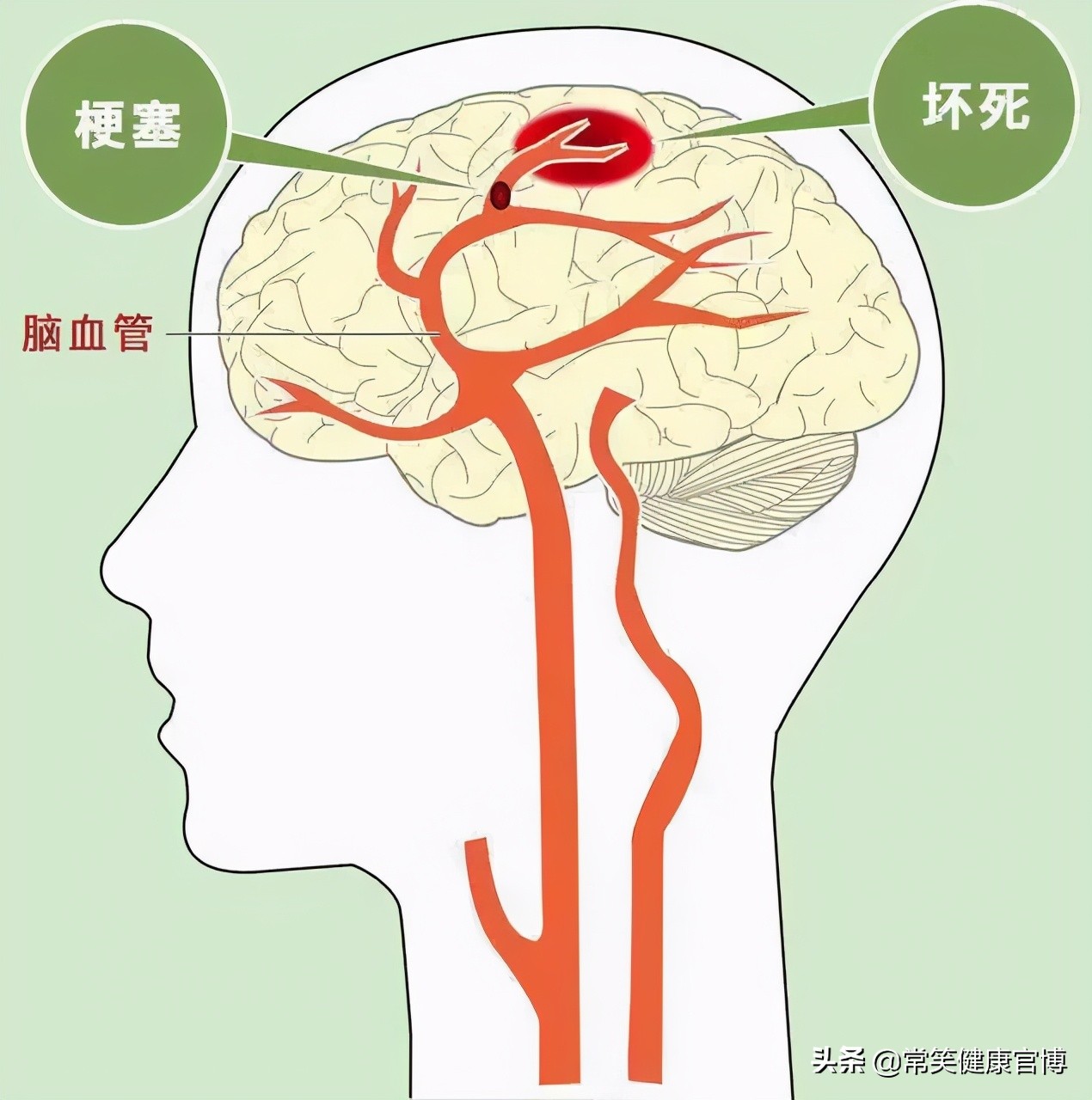 Do you really know stroke?What is the difference between CTA and CT ...