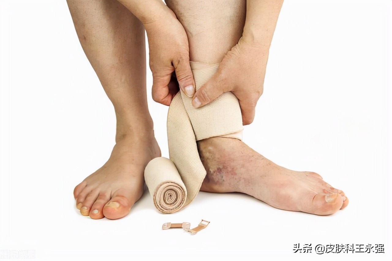 What should I do if a patient with liver cirrhosis has lower extremity ...