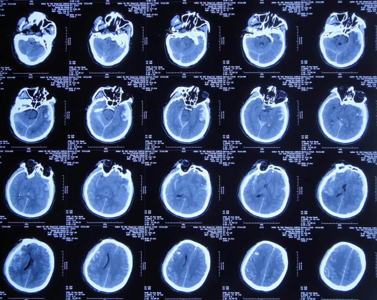 Hydrocephalus after craniocerebral trauma, skull repair caused ...