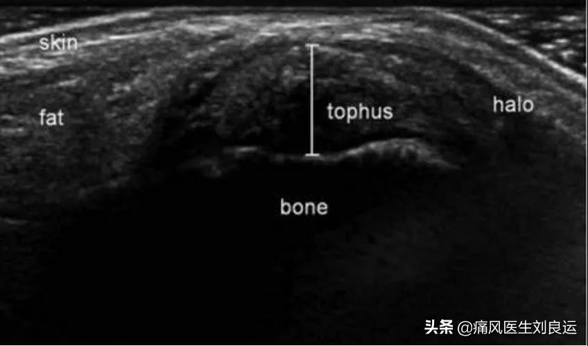 Do gout patients all grow tophi?The doctor introduces four methods of ...