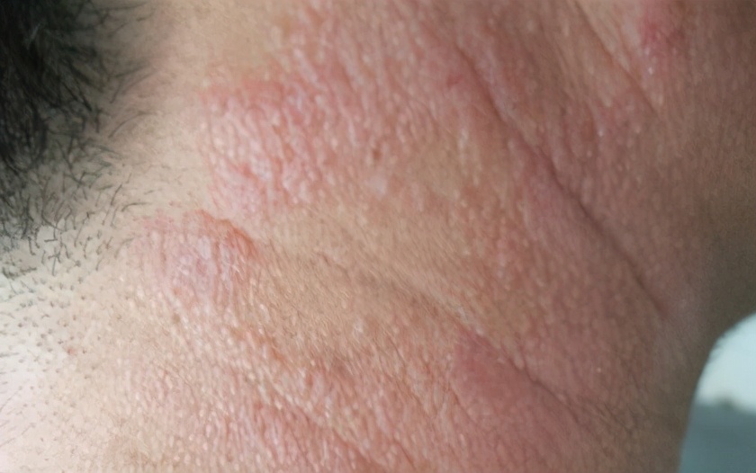 Neurodermatitis, severe itching, how to relieve it? - iNEWS