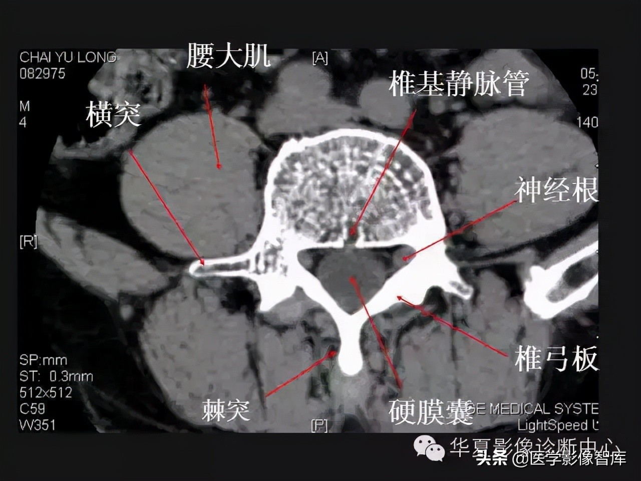 Lumbar imaging anatomy and common lesions - iNEWS