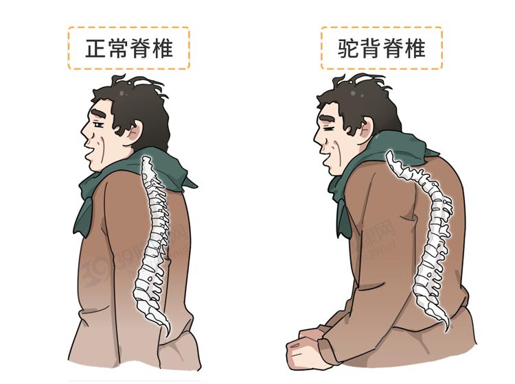 How to eliminate hunchback and forward neck leaning?3 moves, persisted ...