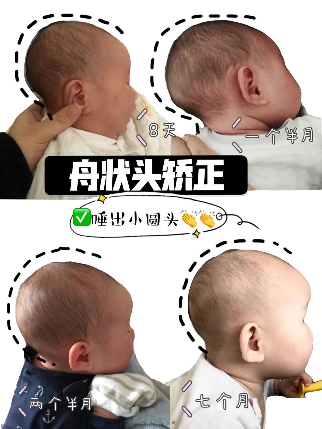 How to give your baby a good head shape!Scaphoid head correction - iNEWS