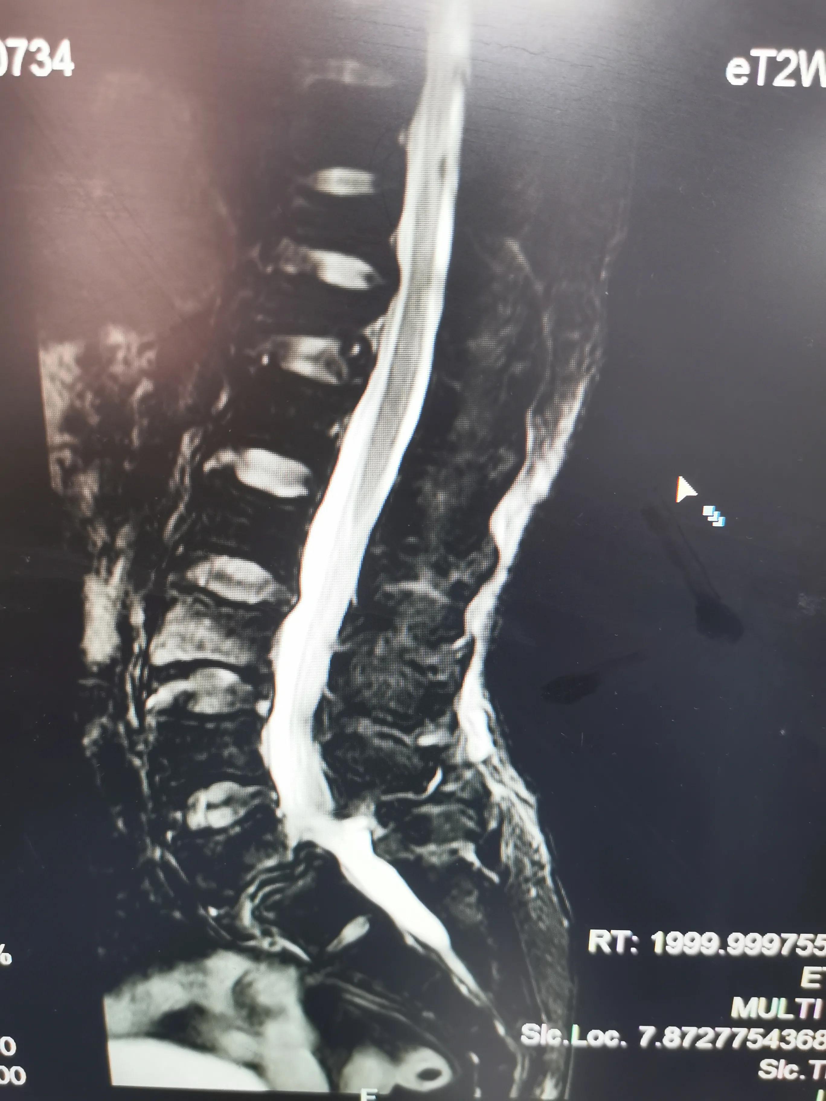 Treatment of osteoporotic compression fractures of lumbar spine in the ...