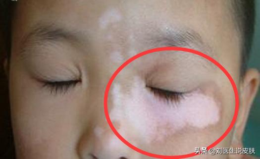 What is the cause of white spots on a child's face?Doctor: It's not ...