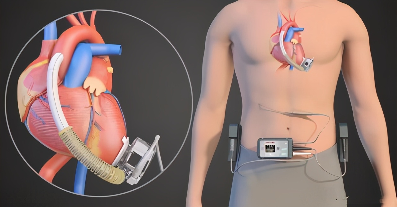 The domestically made full magnetic levitation "artificial heart" comes ...