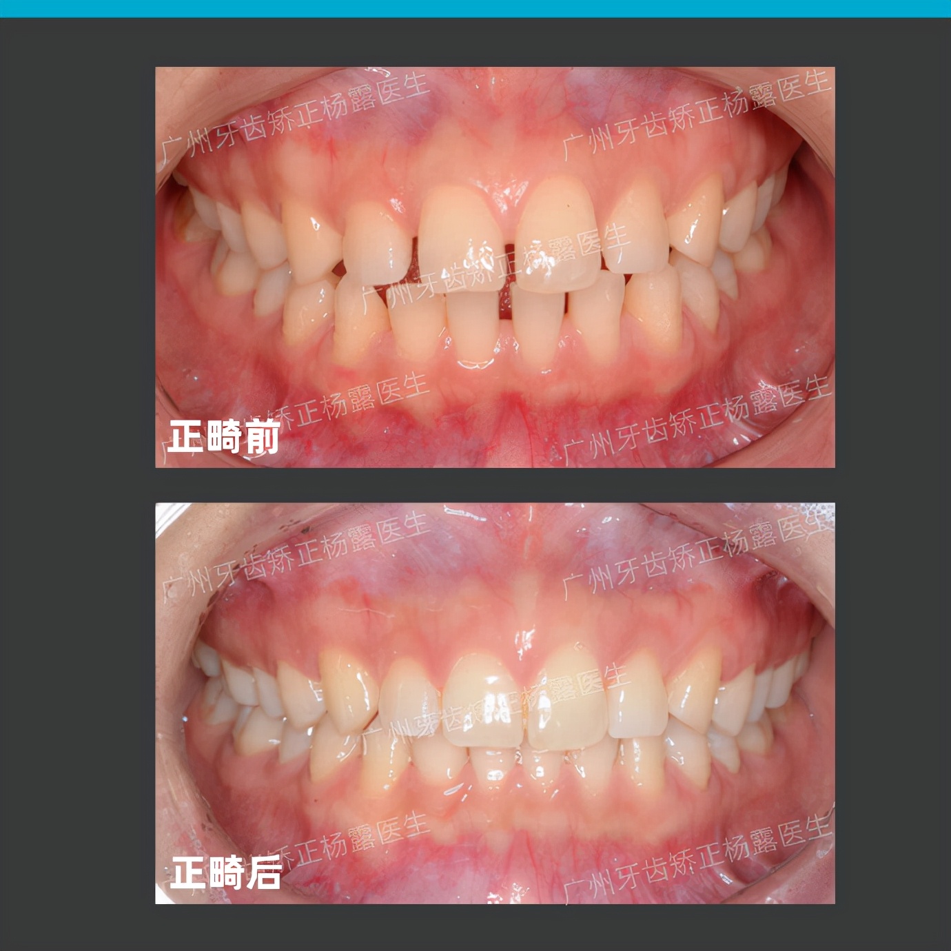 Bone Class I mandibular protrusion + gap between upper and lower ...