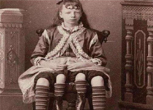 An American girl is born with 4 legs and has been cared by her family ...