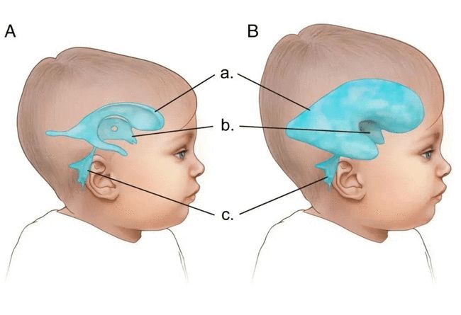 A strange baby in Rwanda, Africa, with a triangular head resembling an ...