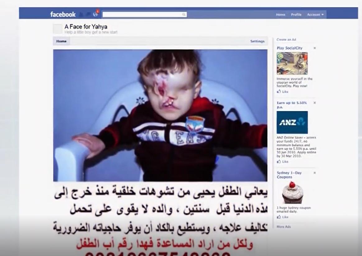 The boy was born without a face. After 19 hours of surgery, his parents ...