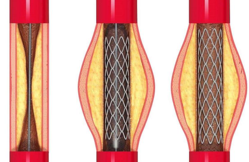 How many years can I live after the heart stent is put in?The doctor ...
