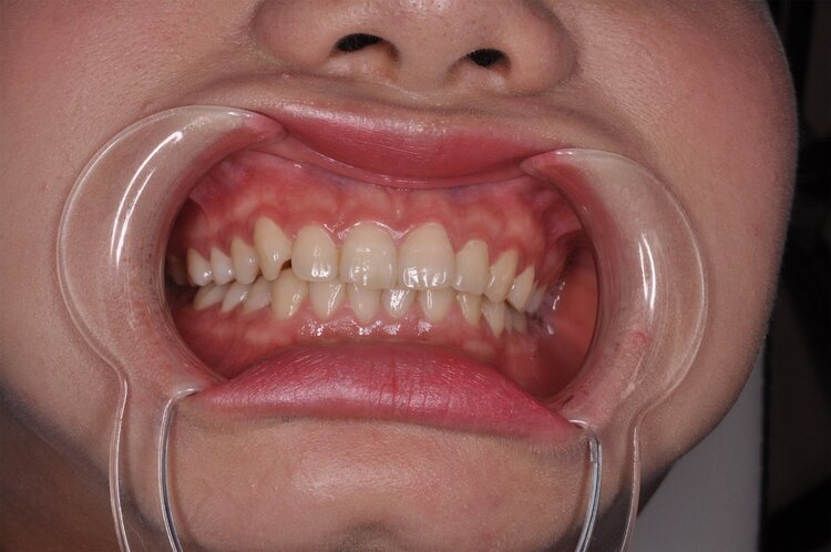 As an Asian country, why are Japanese teeth generally ugly?The main ...