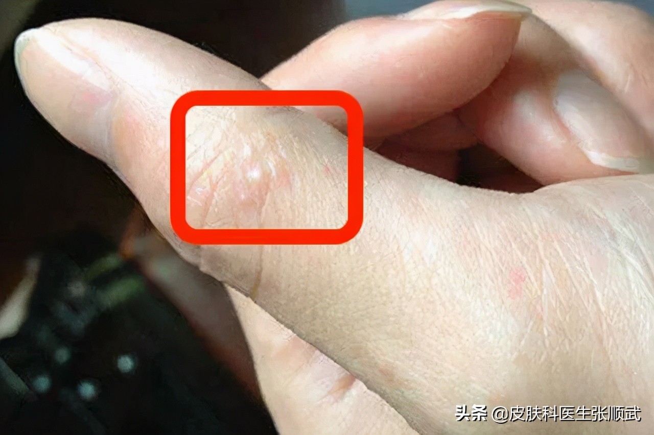 Small blisters on the feet and hands, beware of sweaty herpes - iNEWS