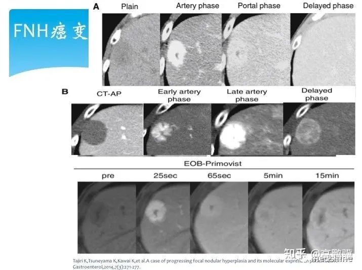 What is FNH (focal nodular hyperplasia of the liver) - iNEWS