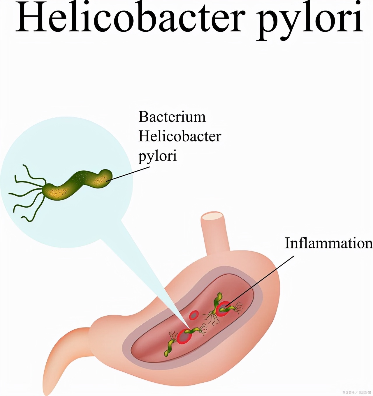 Helicobacter pylori eradication failed?Let's look at these reasons ...