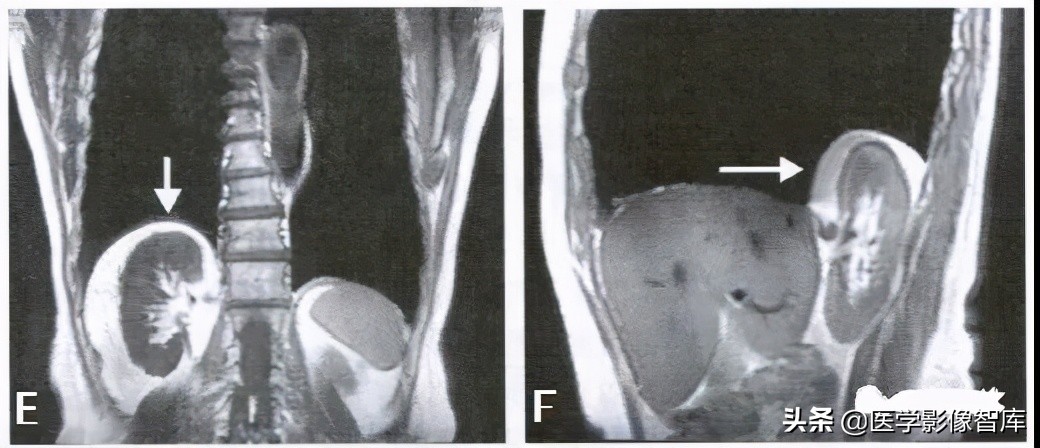 Imaging diagnosis of ectopic thoracic kidney - iNEWS