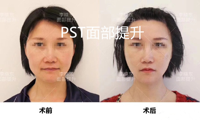 What is the difference between PSV face lift and face lift?Where is the ...