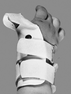 What is a pediatric trigger thumb? - iNEWS