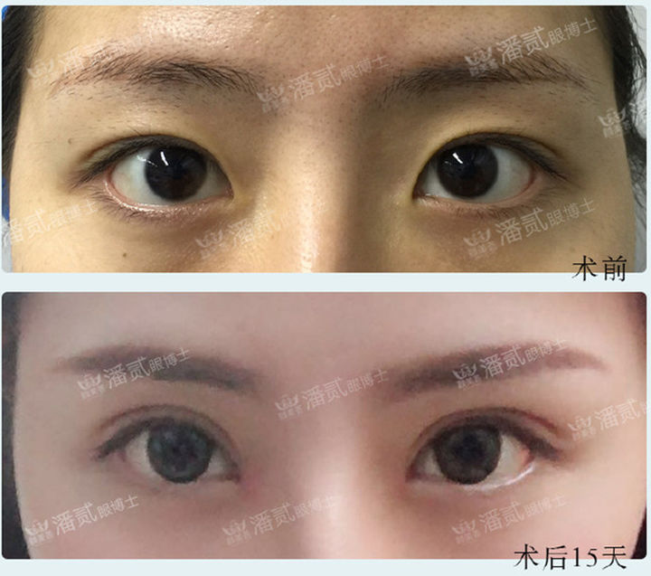 After opening the outer corner of the eye, there is heavy scarring ...