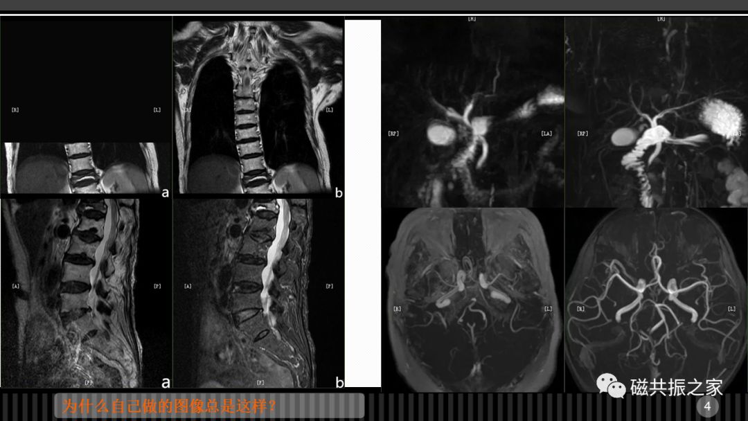 Common MRI artifacts and strategies - iNEWS